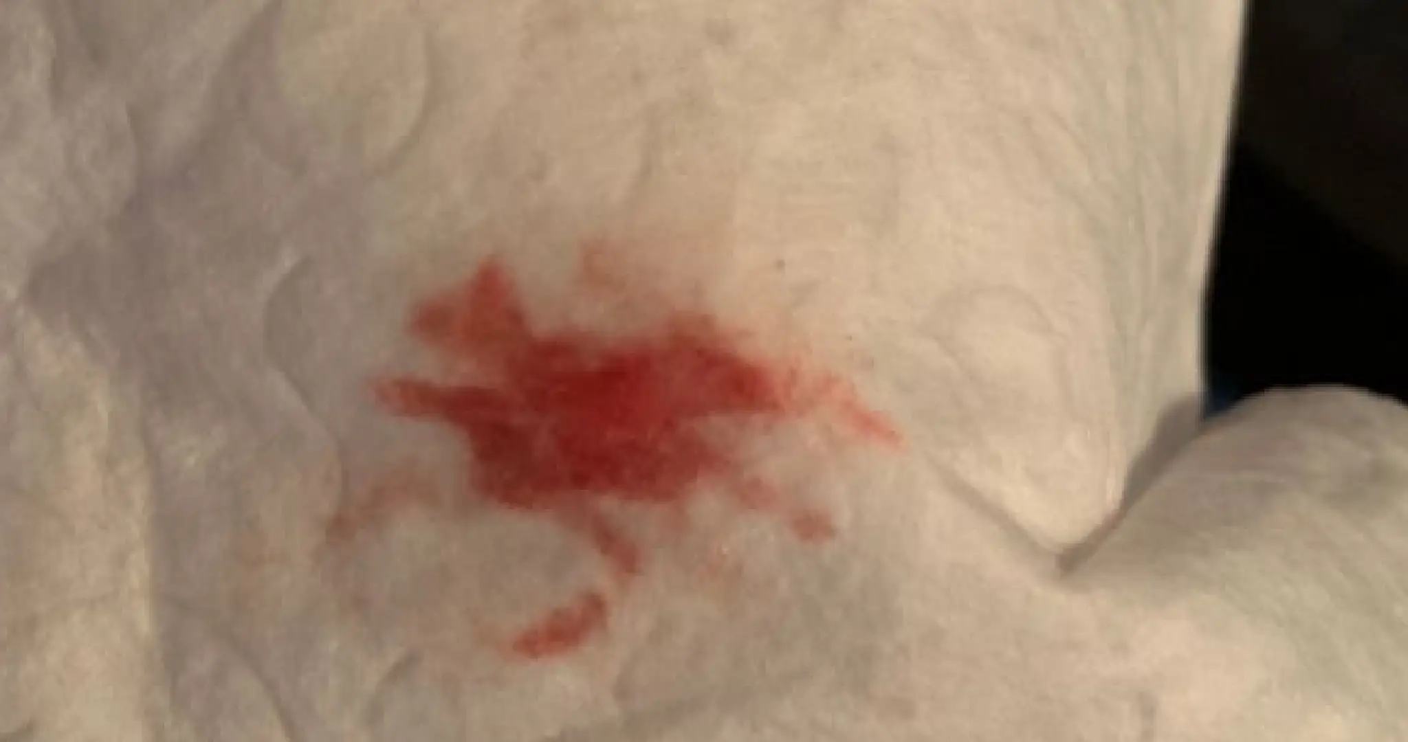 Blood in Diarrhea: Common Causes and Urgent Warning Signs - IMP.NEWS